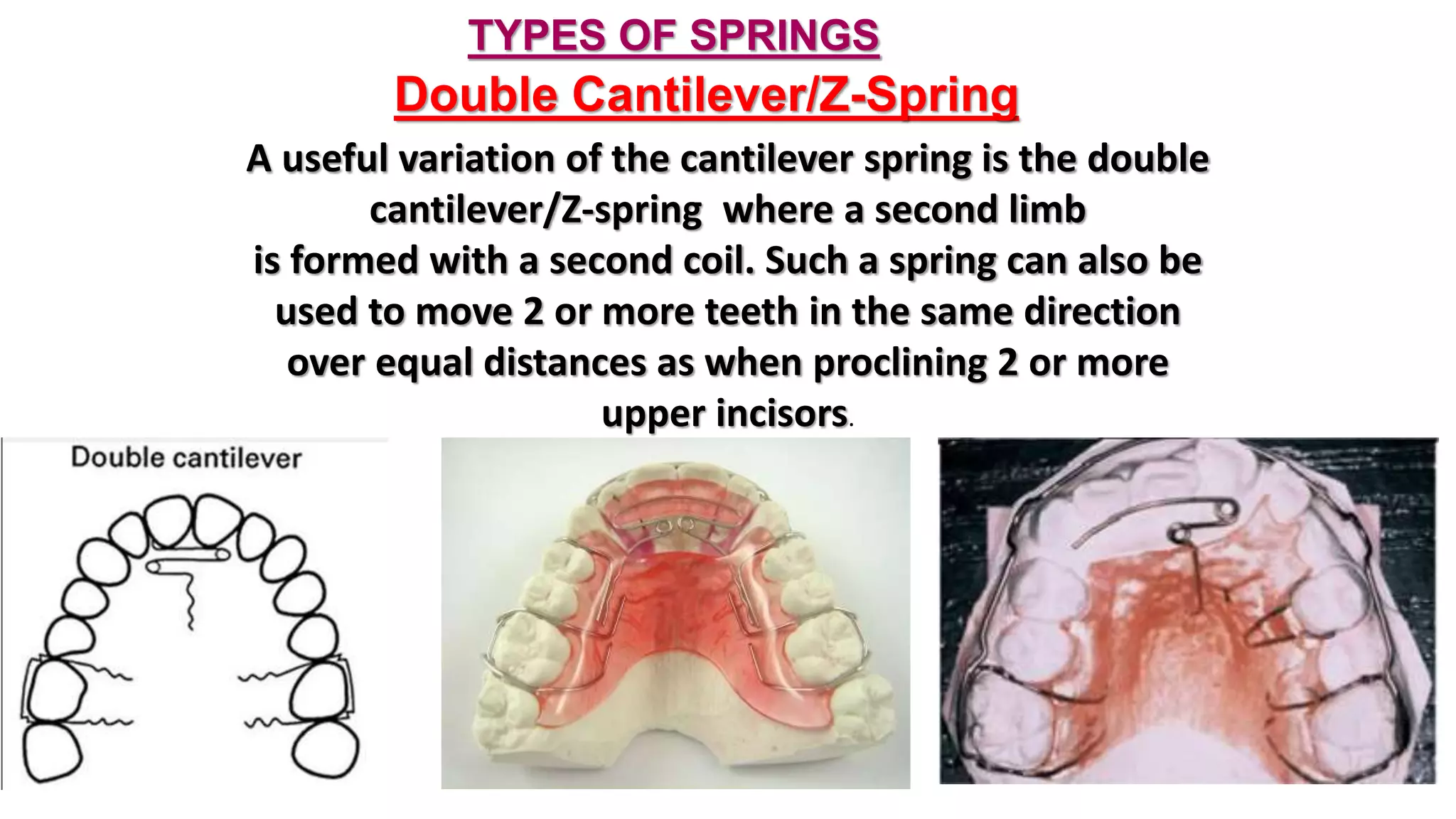 Removable orthodontic appliance | PPTX