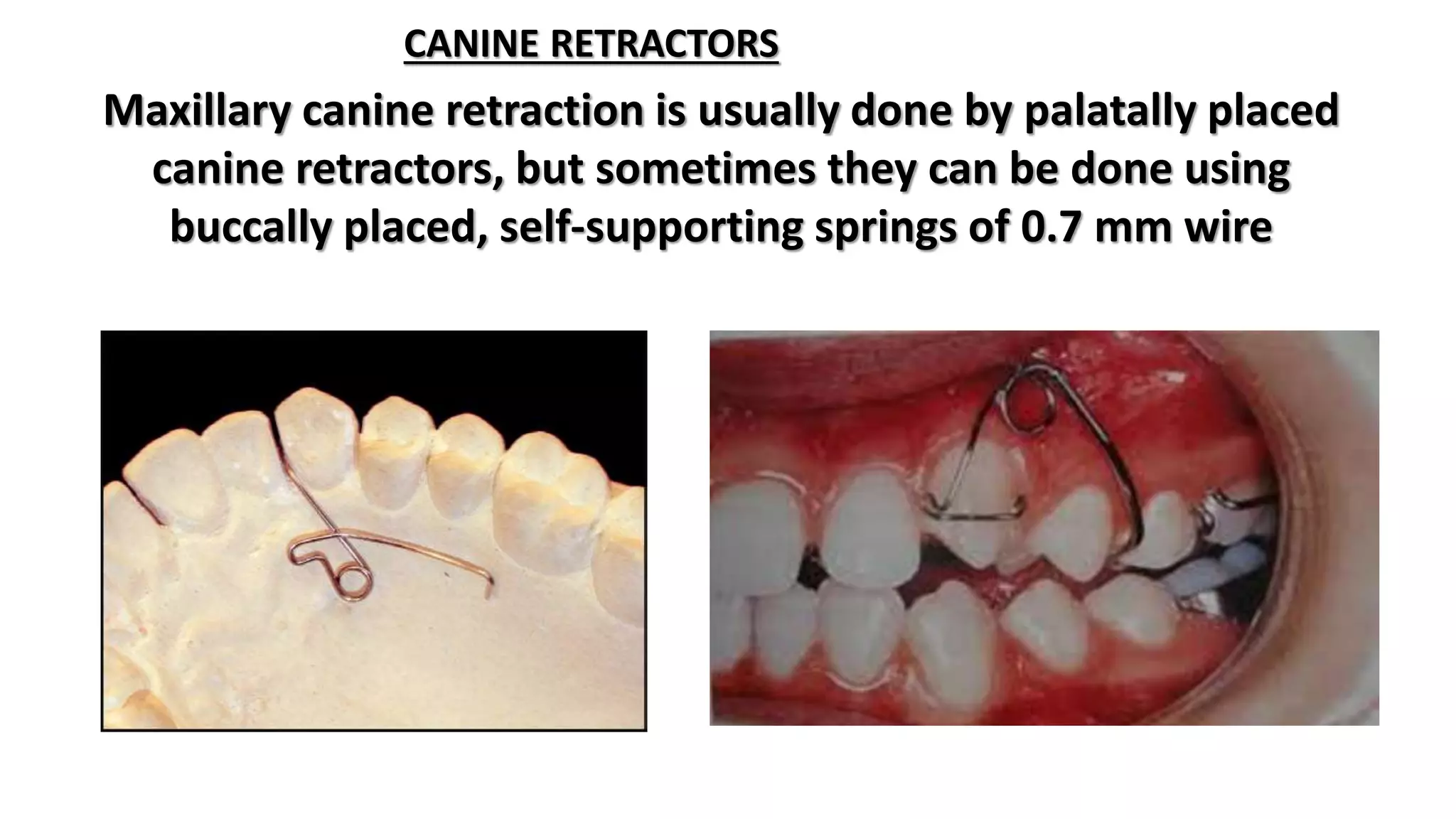 Removable orthodontic appliance | PPTX