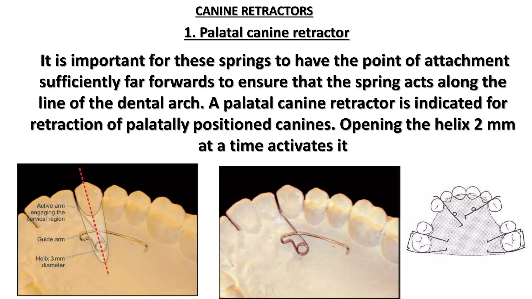 Removable orthodontic appliance | PPTX