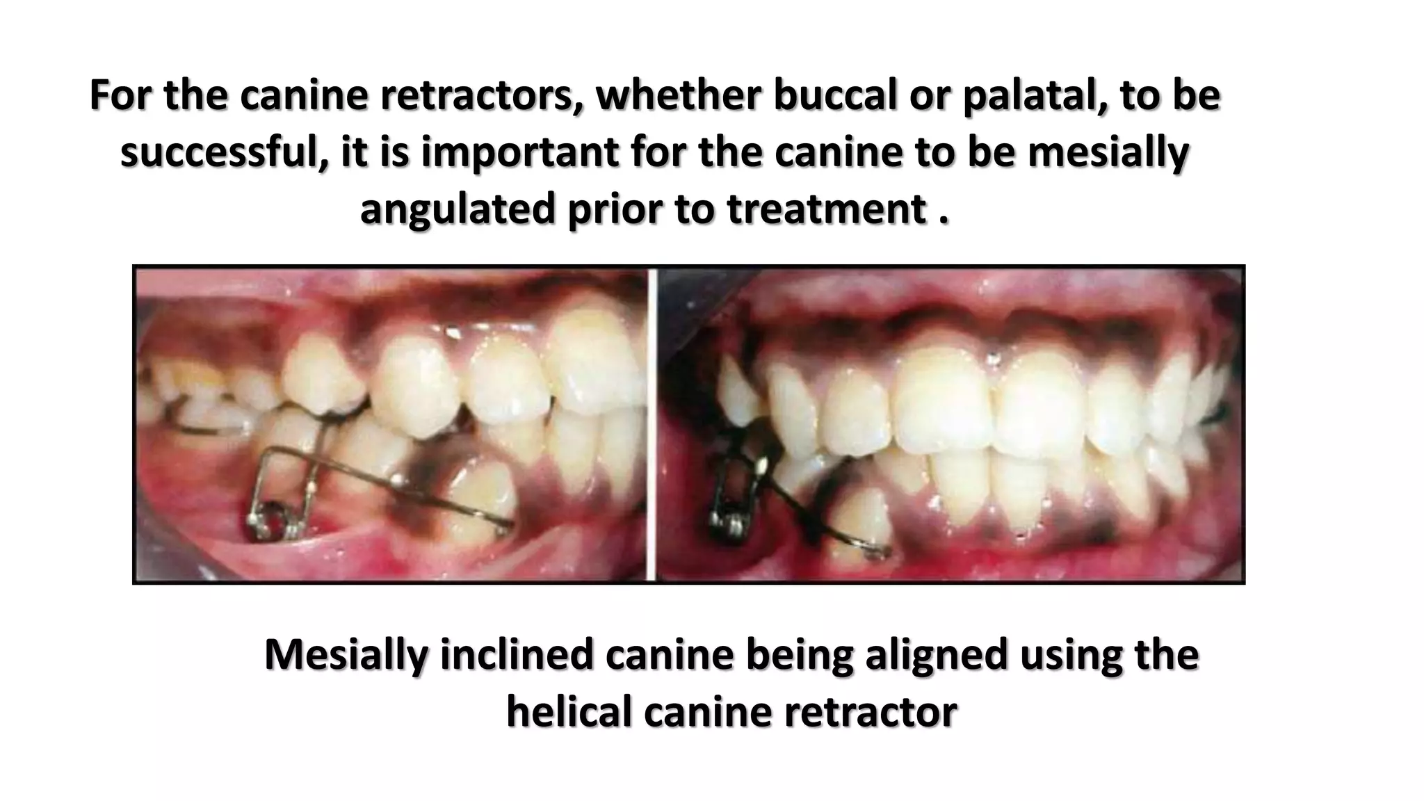 Removable orthodontic appliance | PPTX