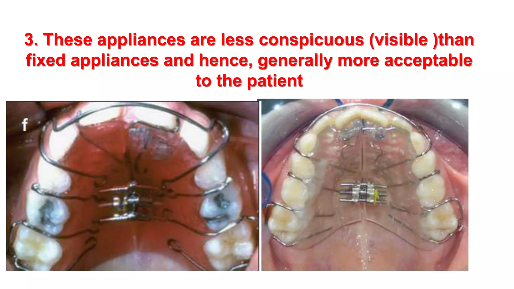 Removable orthodontic appliance | PPTX