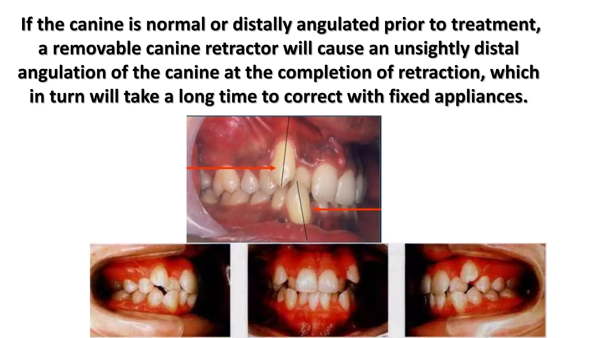 Removable orthodontic appliance | PPTX
