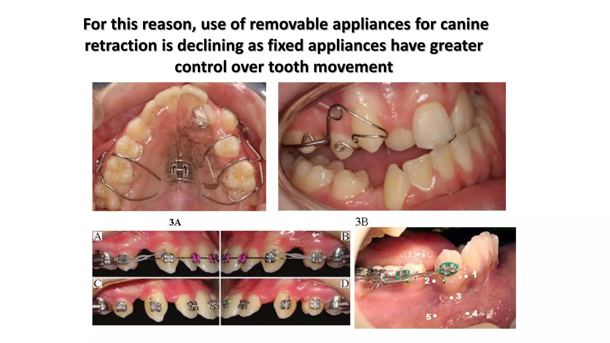 Removable orthodontic appliance | PPTX