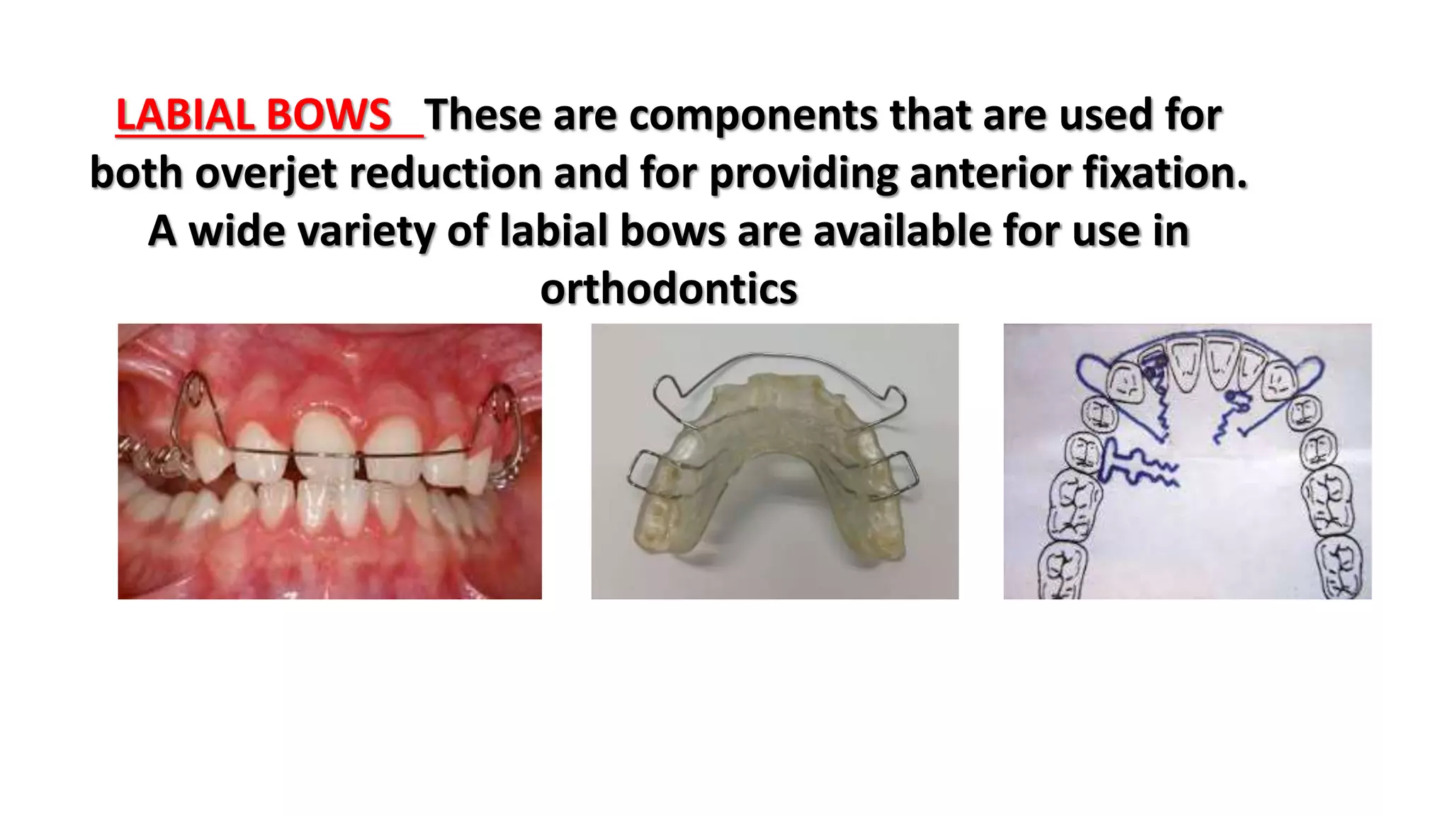 Removable orthodontic appliance | PPTX