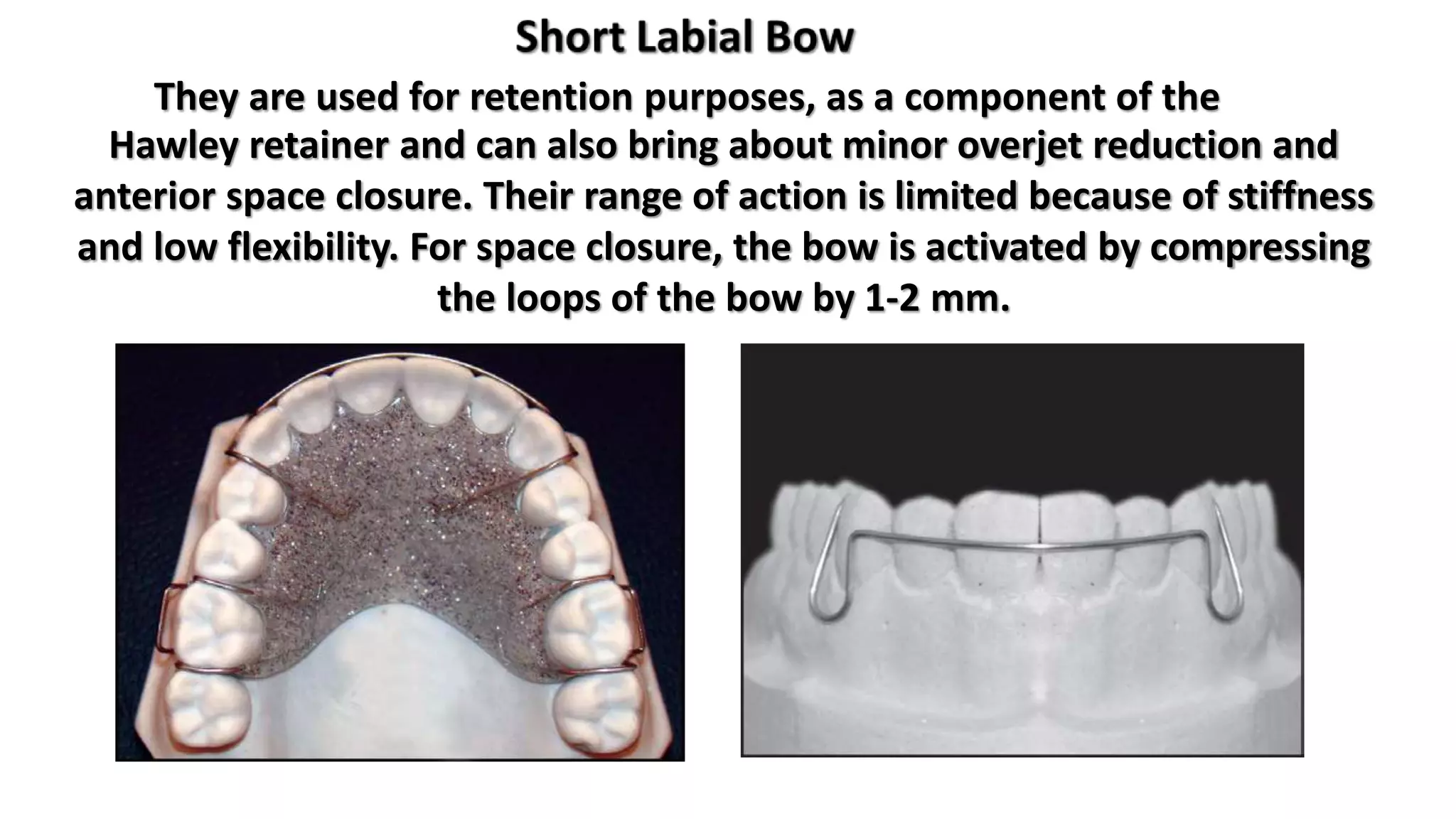 Removable orthodontic appliance | PPTX