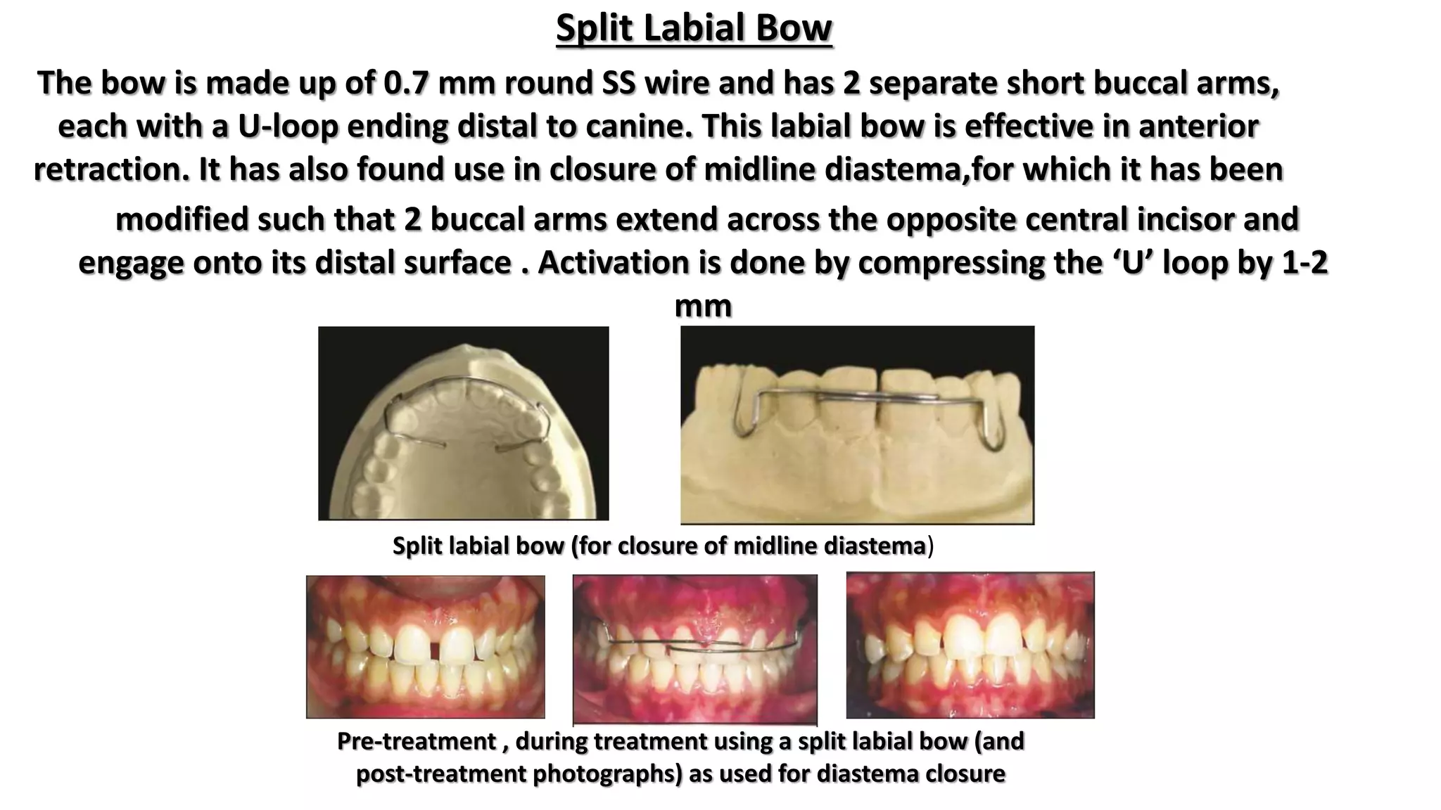 Removable orthodontic appliance | PPTX