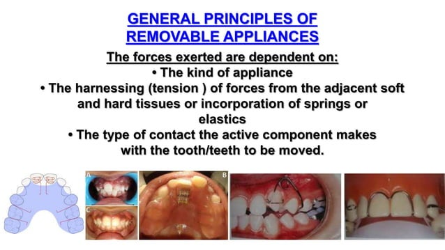 Removable orthodontic appliance | PPTX | Dental Health | Diseases and ...