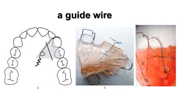 Removable orthodontic appliance | PPTX | Dental Health | Diseases and ...