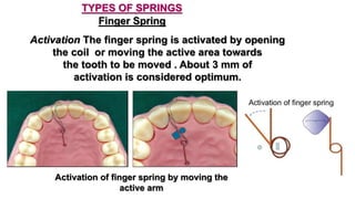 Removable orthodontic appliance | PPTX