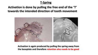 Removable orthodontic appliance | PPTX