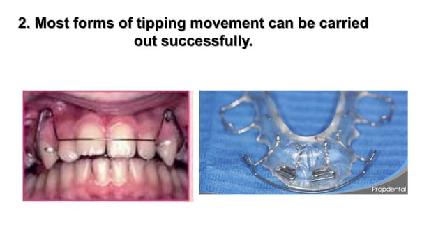 Removable orthodontic appliance | PPTX | Dental Health | Diseases and ...