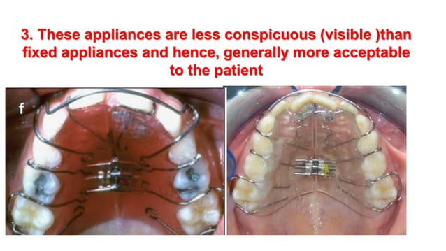 Removable orthodontic appliance | PPTX | Dental Health | Diseases and ...