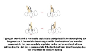 Removable orthodontic appliance | PPTX