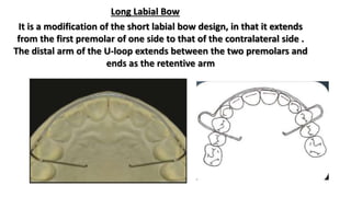 Removable orthodontic appliance | PPTX