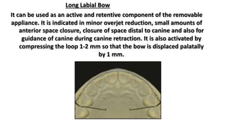 Removable orthodontic appliance | PPTX