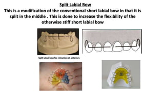 Removable orthodontic appliance | PPTX
