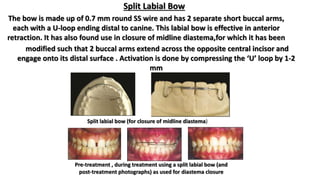 Removable orthodontic appliance | PPTX