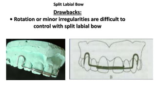 Removable orthodontic appliance | PPTX