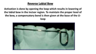 Removable orthodontic appliance | PPTX