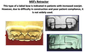 Removable orthodontic appliance | PPTX
