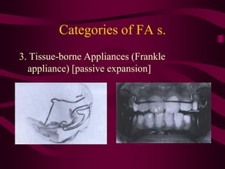 Removable Orthodontic Appliances | PDF