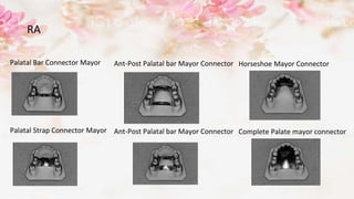 Removable Parial Denture.pptx
