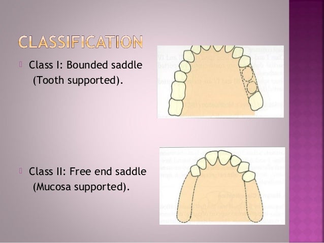 Removable partial denture