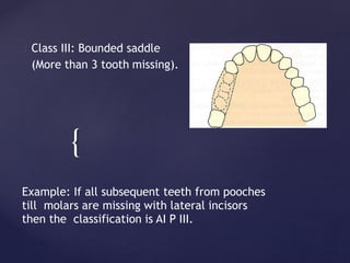 Removable Partial Denture Made In U.S.A | PPT