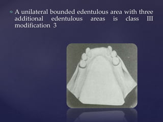 Removable Partial Denture Made In U.S.A | PPT
