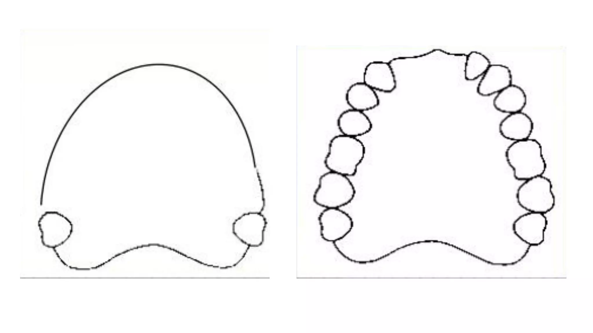Removable partial denture introduction (part 1) | PDF
