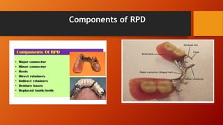 Removable partial denture | PPT