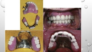 Removable Partial denture پروستودنتیکس سوم ۱.pptx