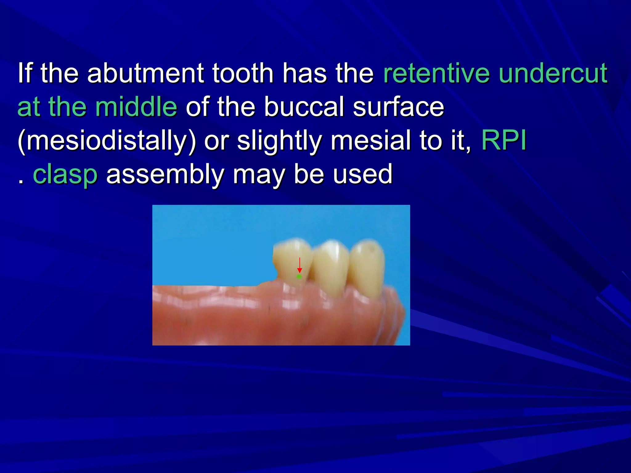 Removable partial denture design clasp selection according to the ...