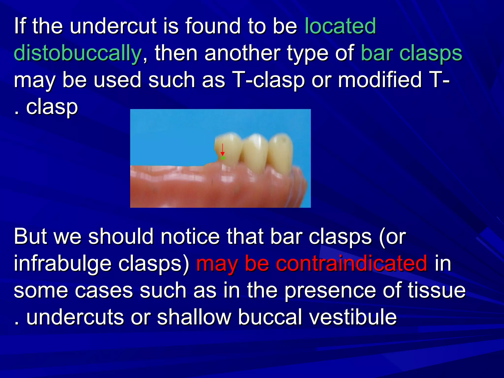 Removable partial denture design clasp selection according to the ...
