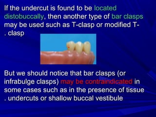 Removable partial denture design clasp selection according to the ...