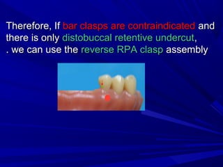 Removable partial denture design clasp selection according to the ...