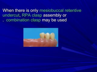 Removable partial denture design clasp selection according to the ...