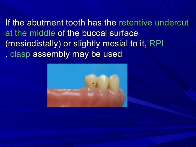 Removable partial denture design clasp selection according to the p…