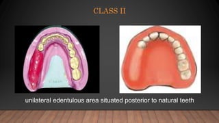 Removable partial dentures | PPT