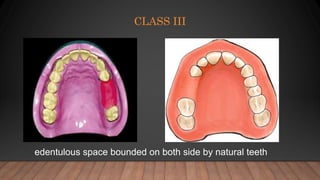 Removable partial dentures | PPT