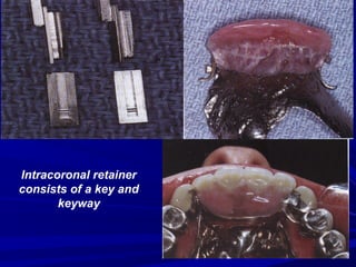 Removable partial dentures(direct retiner) (1) | PPT