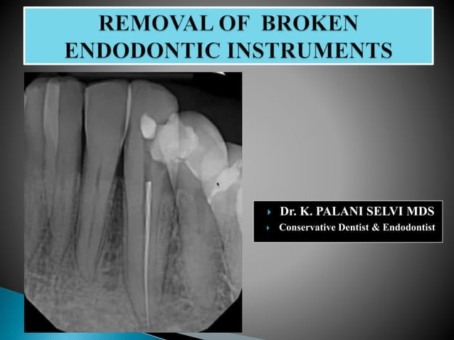 Removal of broken endodontic instruments | PPTX