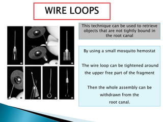 Removal of broken endodontic instruments | PPTX