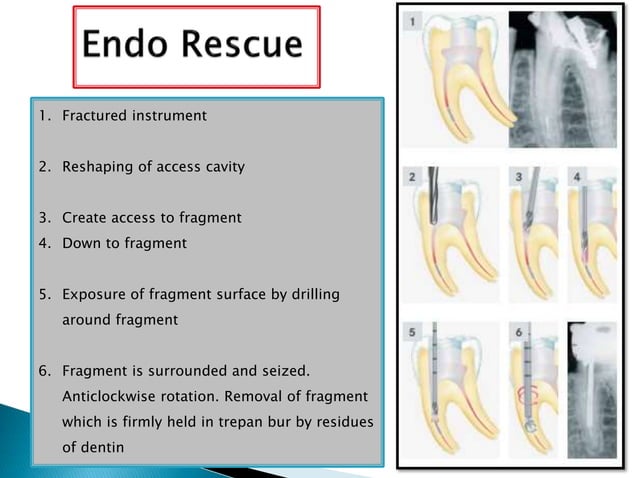Removal of broken endodontic instruments | PPTX