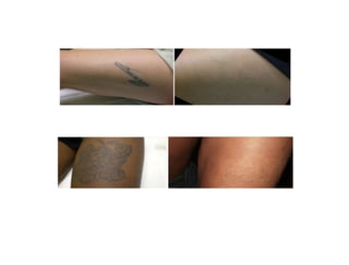 Remove Tattoo Without Pain | DOCX
