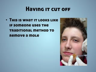 Removing a mole: What they are and how to get rid of them | PDF
