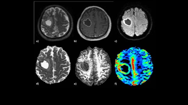 CNS LYMPHOMA RADIOLOGY | PPTX | Brain and Nervous System Disorders ...
