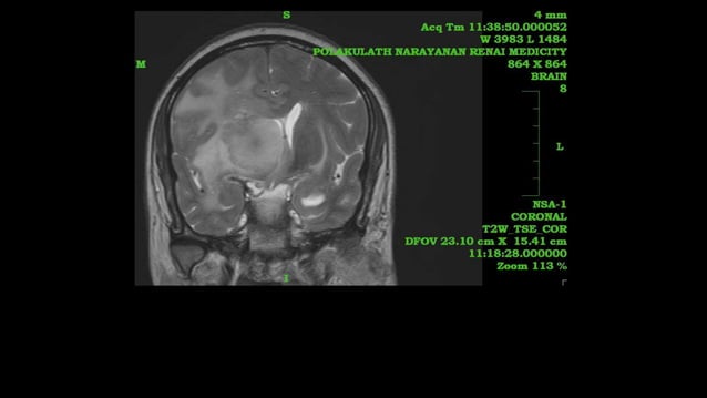 CNS LYMPHOMA RADIOLOGY | PPTX | Brain and Nervous System Disorders ...