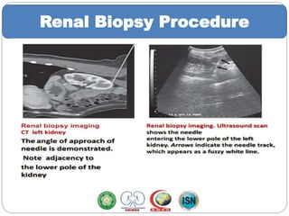 Renal biopsy | PPTX