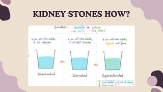 Nephrolithiasis, pathophysiology and types | PDF